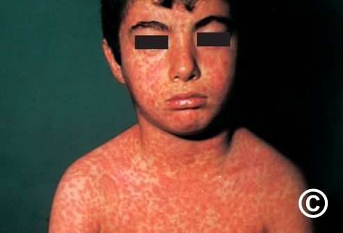 Viral Exanthem Face