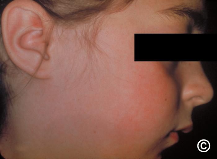 Viral Rash On Face