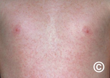 Viral Exanthem