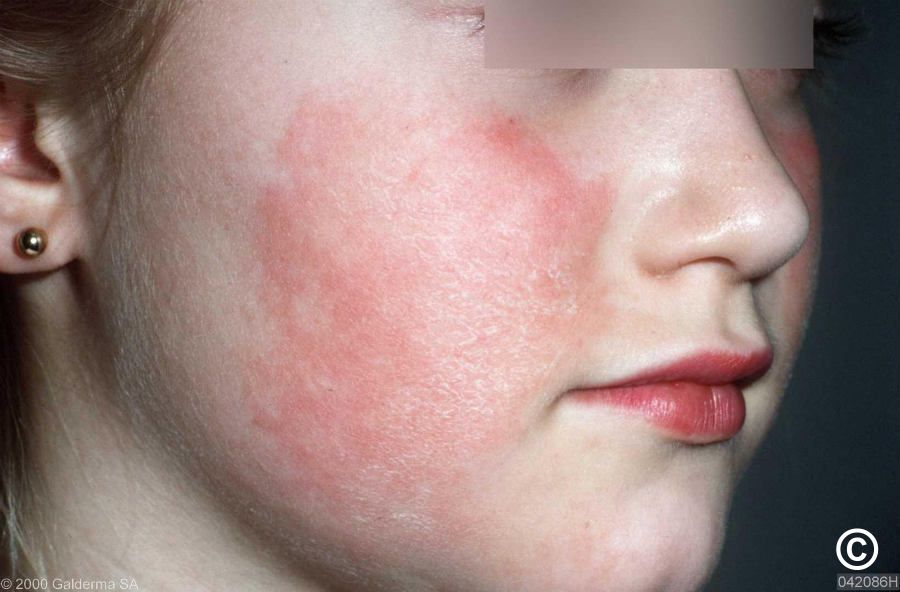 Images Of Slapped Cheek Disease