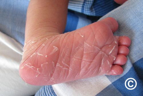 Scarlet fever (syn. scarlatina)