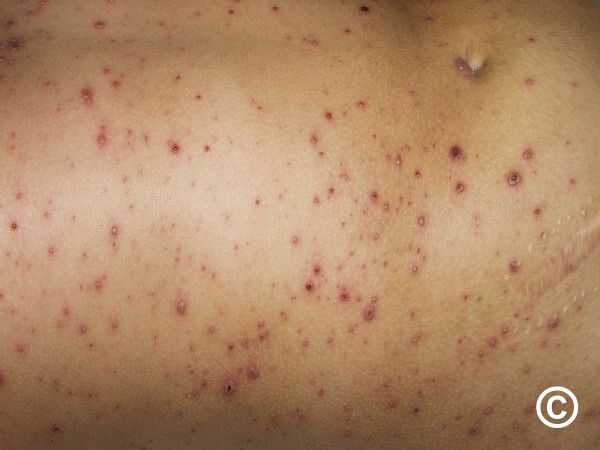 Rash Exanthem Approach To Exanthem Maculopapular Rash, Exanthem,