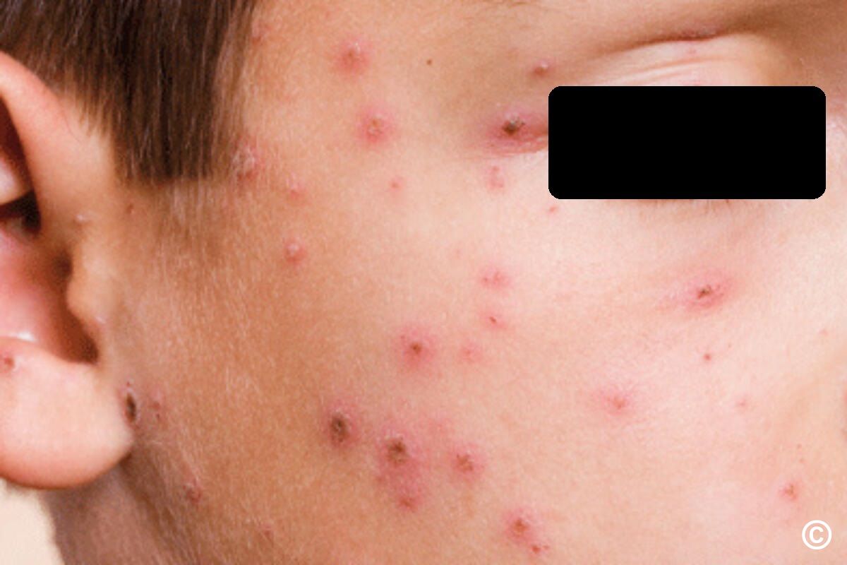 Viral Rash Exanthem Wikipedia