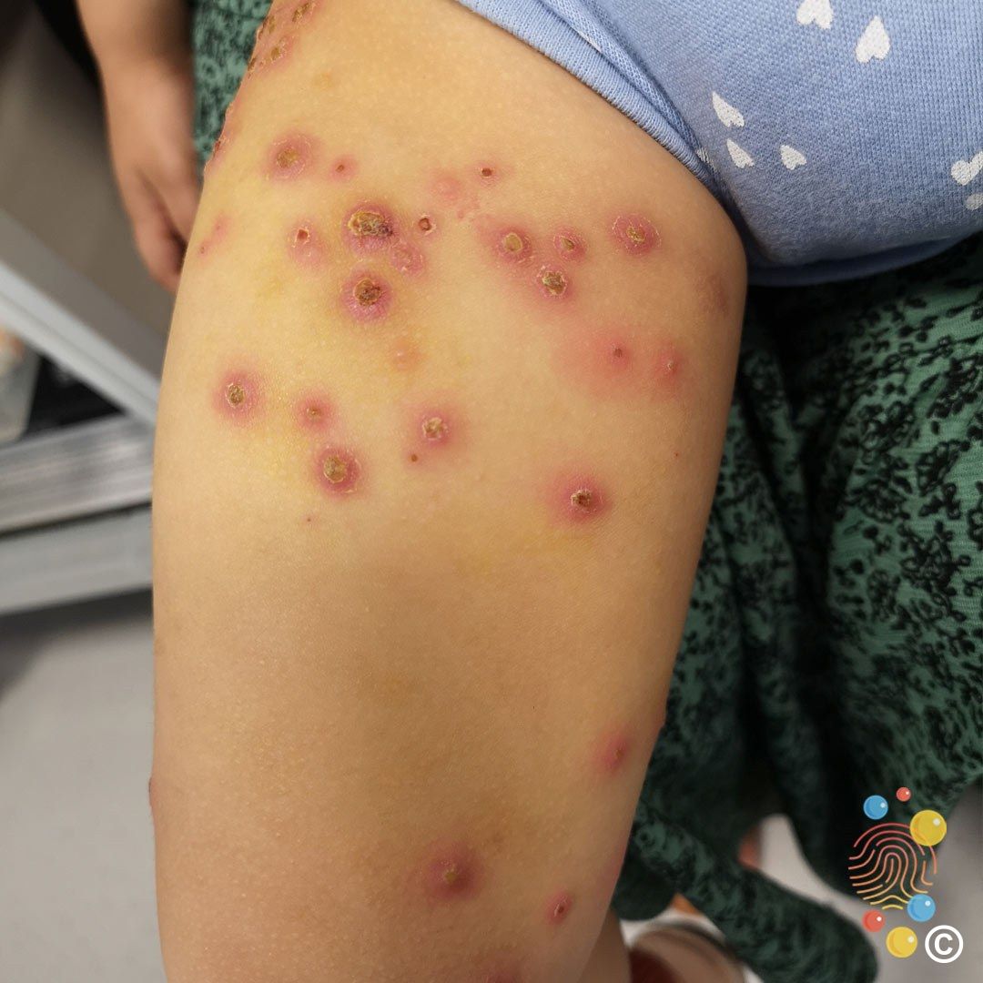 Chicken Pox Macule Stage
