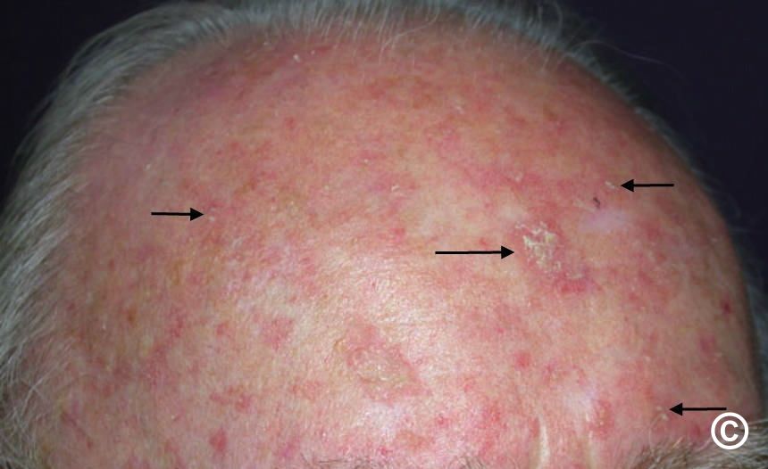 Actinic keratosis, solar keratosis