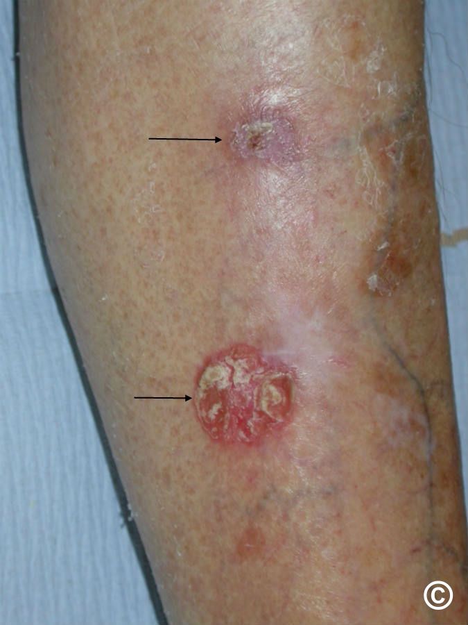 Bowen Disease Pictures On Face